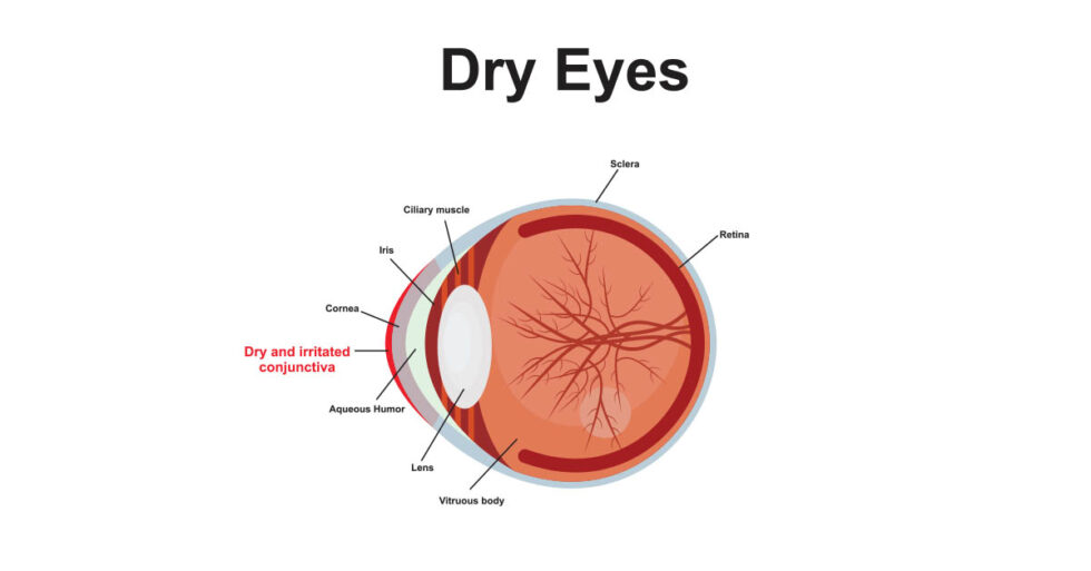 Dry Eye Disease: The Itch You Can’t Scratch - Medchoice