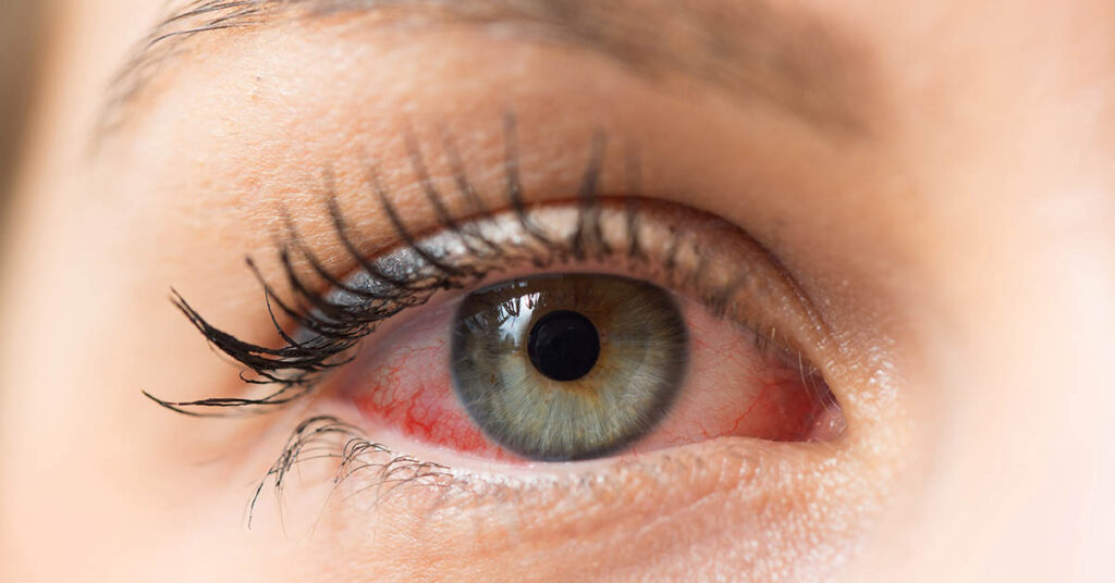 Dry Eye Disease: The Itch You Can’t Scratch - Medchoice